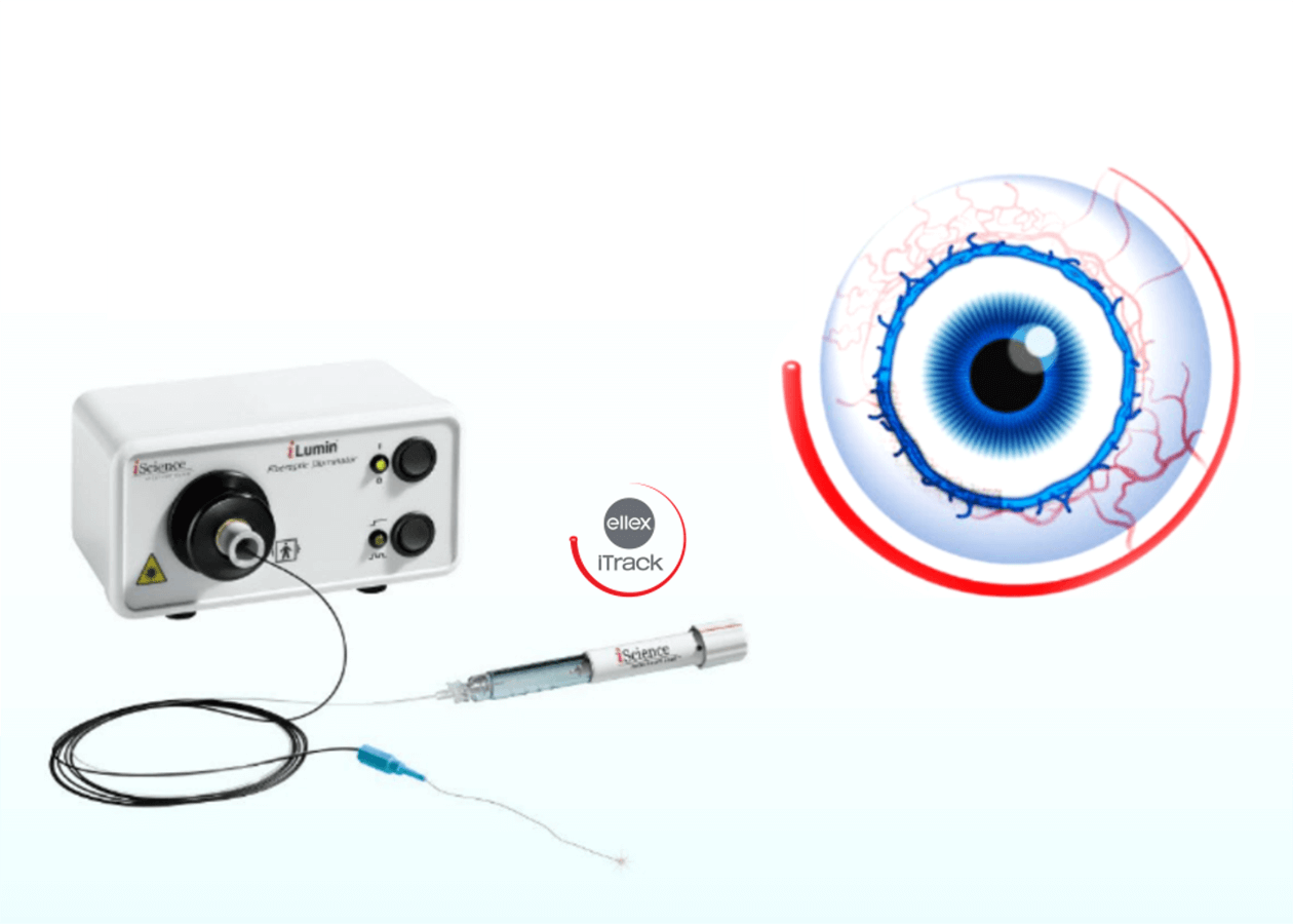 Ab-interno Canaloplasty (ABiC™) - David Richardson, MD - Glaucoma ...